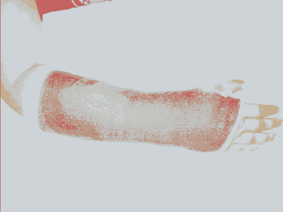 Accidentes de motos |las 8 lesiones más frecuentes - BlogdelaMoto.com